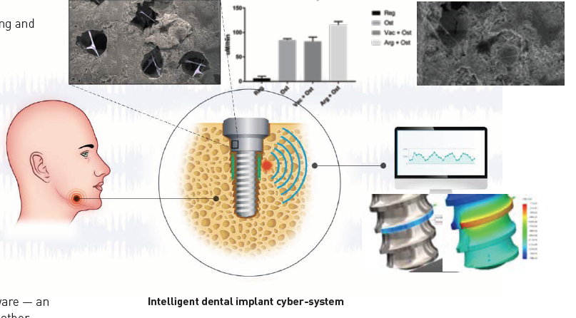 Toward Smart Dental Implants – Mechanical Engineering